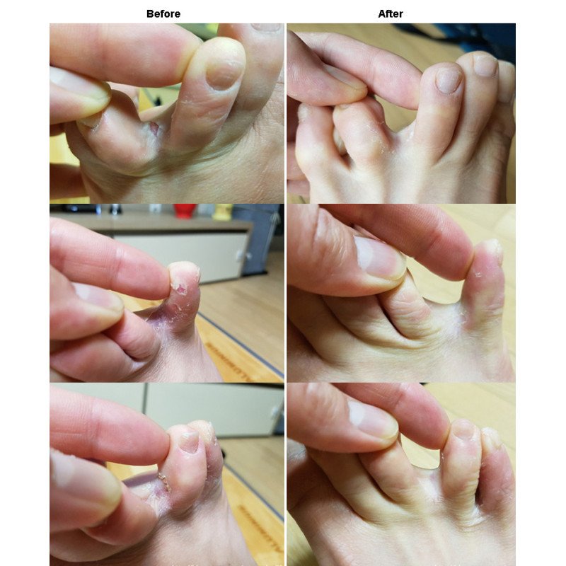120pcs Athlete's Foot Between Toes Care Fungus Odor Treatment Absorbing ...